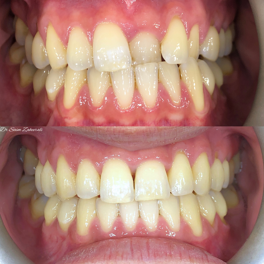 Transform Your Smile with Confidence: A Guide to Dental Implants, Invisalign, and Composite ...